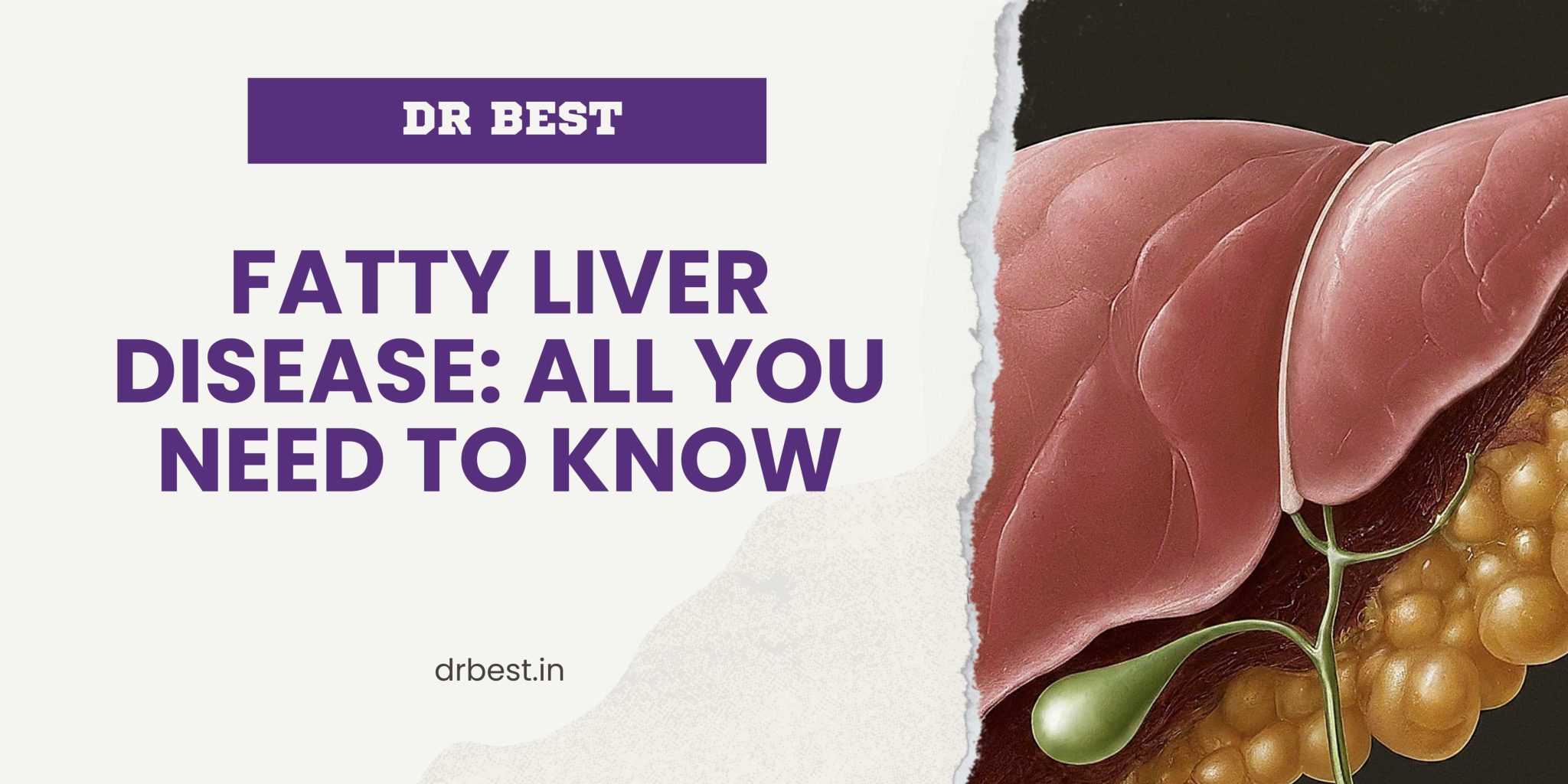 Fatty Liver Disease: All You Need To Know - Dr Best